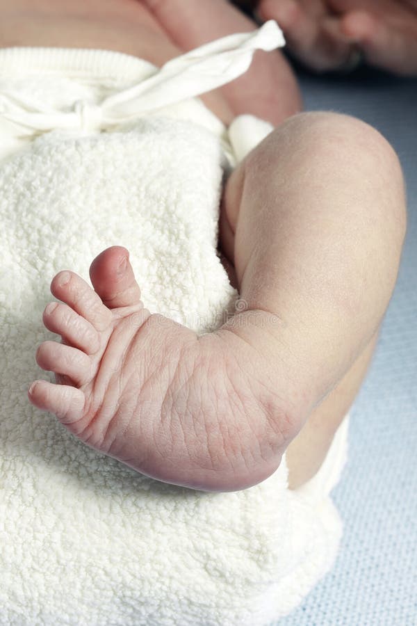 Newborn with Bilateral Club Foot Stock Photo - Image of care ...