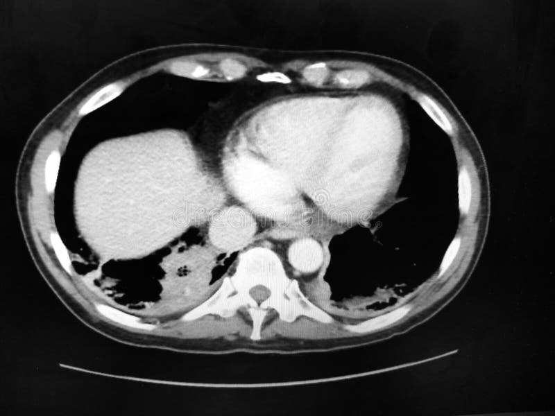 Coccidioides Imitis Right Lower Lung Cavitary Pneumonia Stock Photo ...