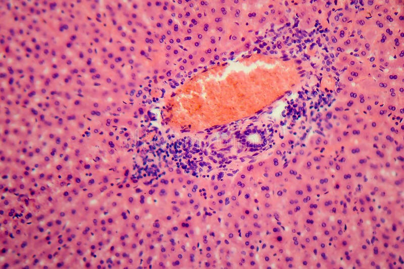 Coccidiosis, Coccidia in Liver, Light Micrograph Stock Photo - Image of ...