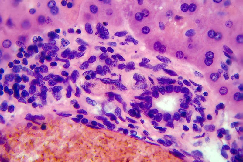 Coccidiosis, Coccidia in Liver, Light Micrograph Stock Photo - Image of ...