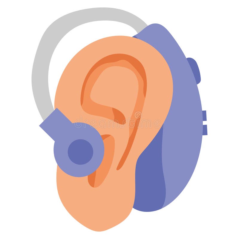 Cochlear implant in ear stock vector. Illustration of electronic ...