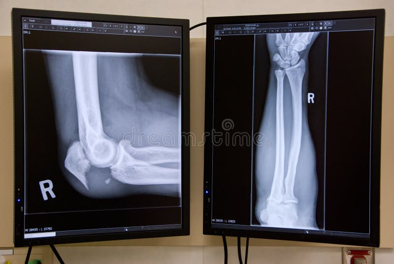 Codo quebrado imagen de archivo. Imagen de medicina, roto - 10926895