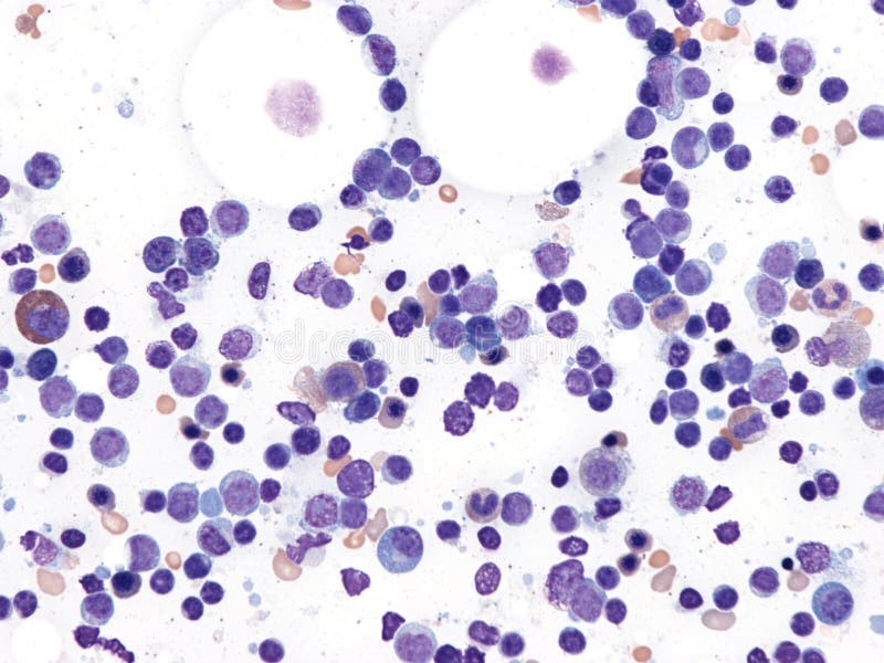 Chronic Lymphatic Leukemia and Lymphoplasmacytic Lymphoma in Bone ...