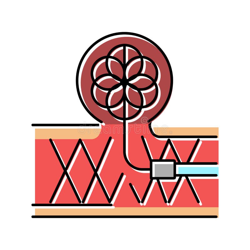 Coil Embolization Stock Illustrations – 171 Coil Embolization Stock ...