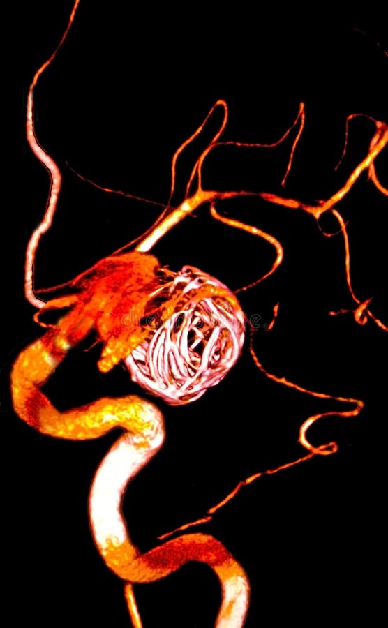 Angiography stock photo. Image of rendering, isolated - 106496700