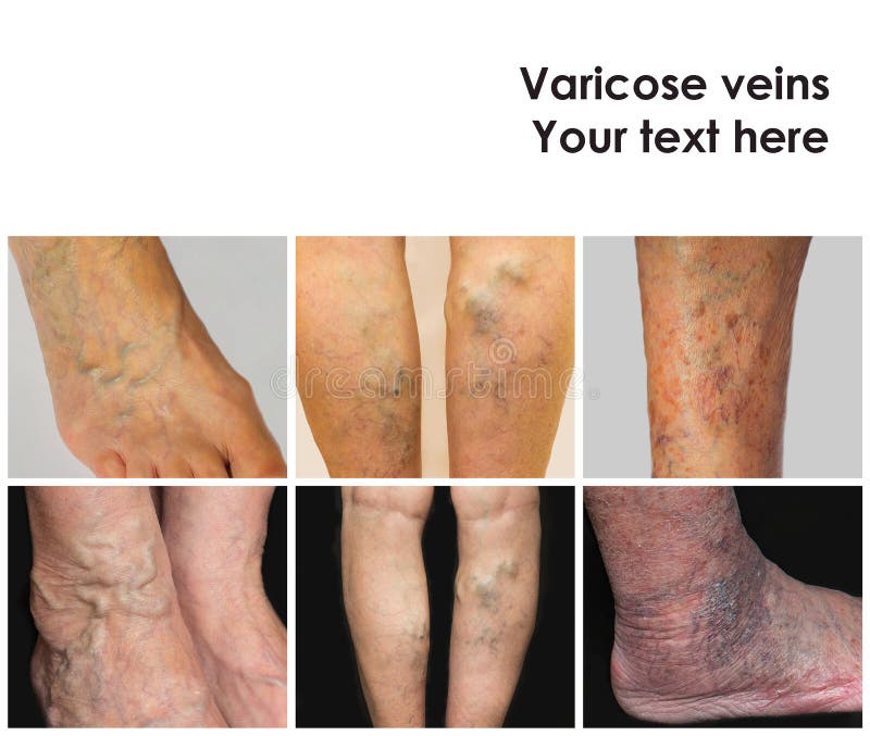 Colagem Das Imagens Das Veias Varicosas Foto de Stock - Imagem de edema ...