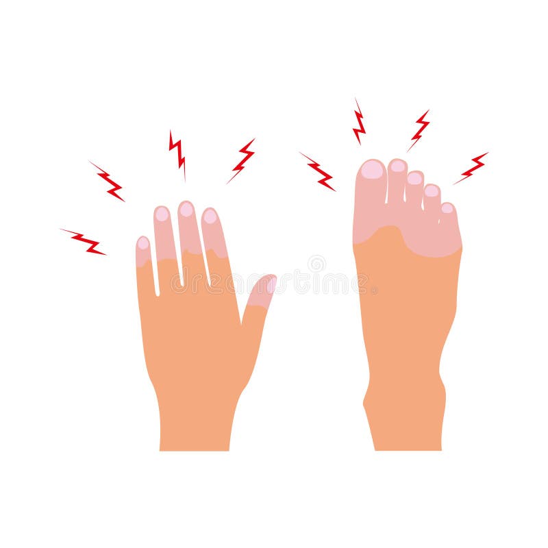 Cold and Numbness at the Fingertips. Vector Illustration of Feet and ...