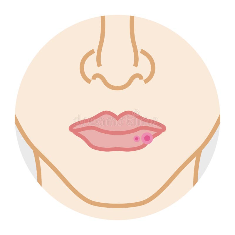 Cold Sore - Face Close-up stock vector. Illustration of cold - 91297372