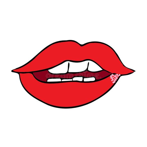 Cold Sore on Lips Medical Illustration - 1 Stock Illustration ...