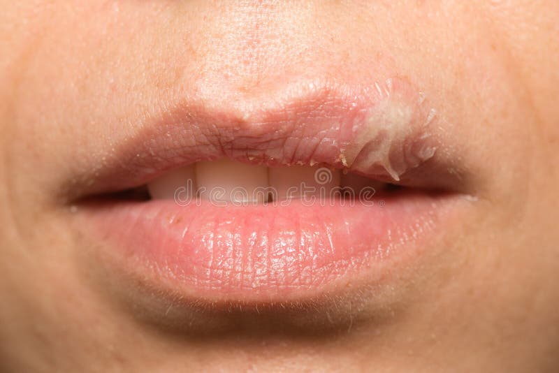 Cold sore stock photo. Image of crusted, skin, illness - 58504700