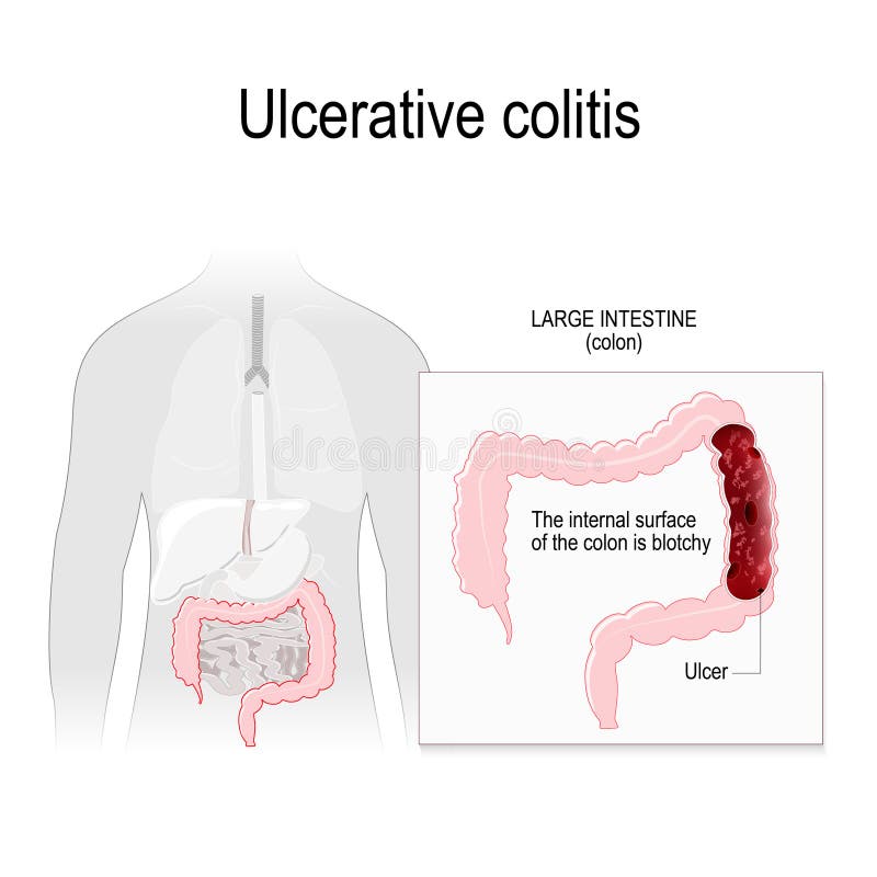 Colite Ulcerativa UC, Infiammazione E Ulcere Del Colon E Del Retto ...
