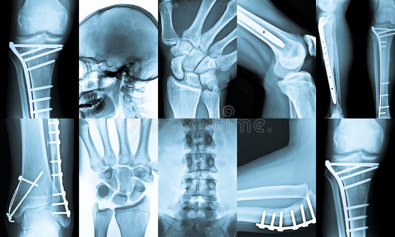 Collage de la radiografía foto de archivo. Imagen de placa - 23559314