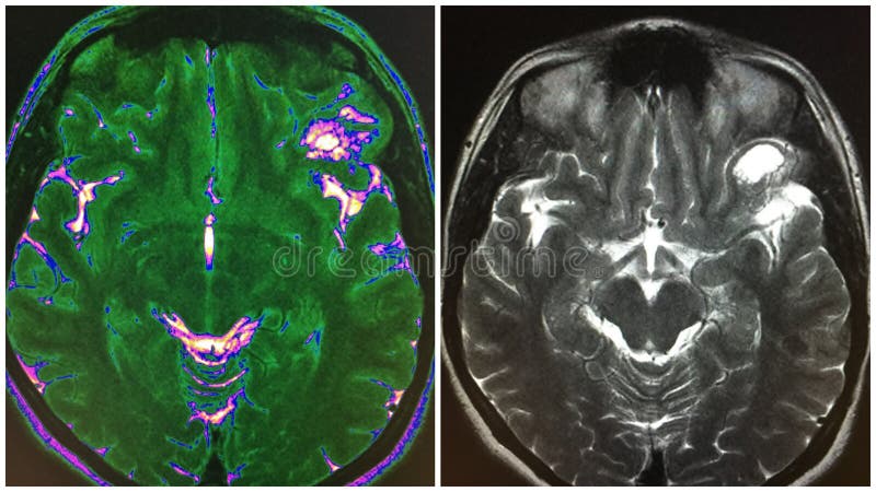 Collage Frontal Inférieur De Structure De Dnet De Cerveau De Mri Image ...