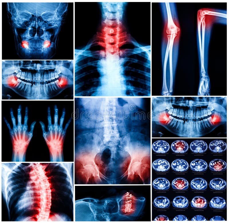 Collage of Human X-rays Photo Stock Image - Image of scan, radiology ...