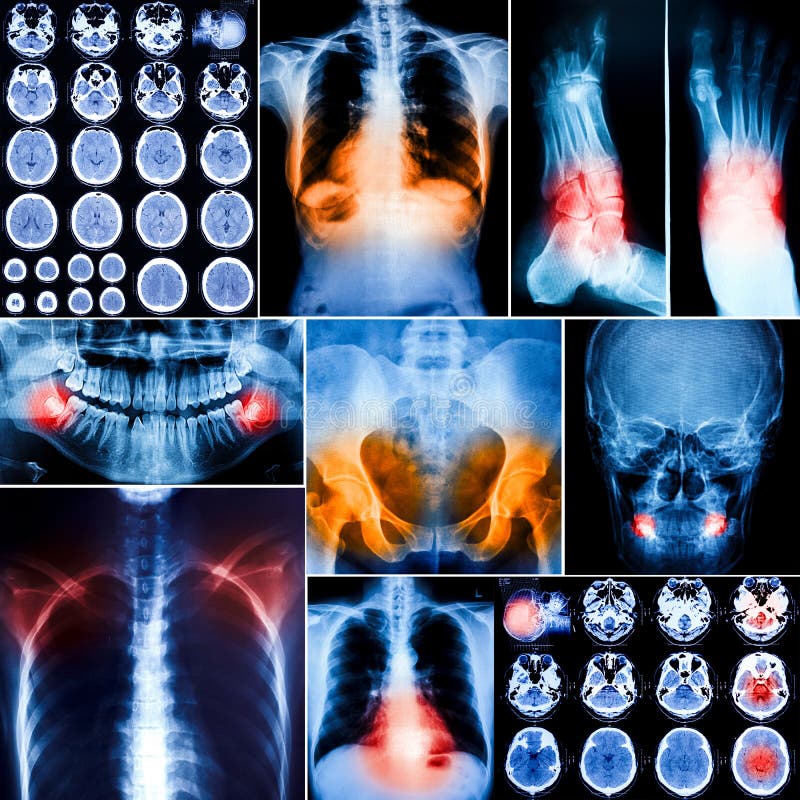 Collage of Human X-rays Photo Stock Photo - Image of injury, bone: 45285608