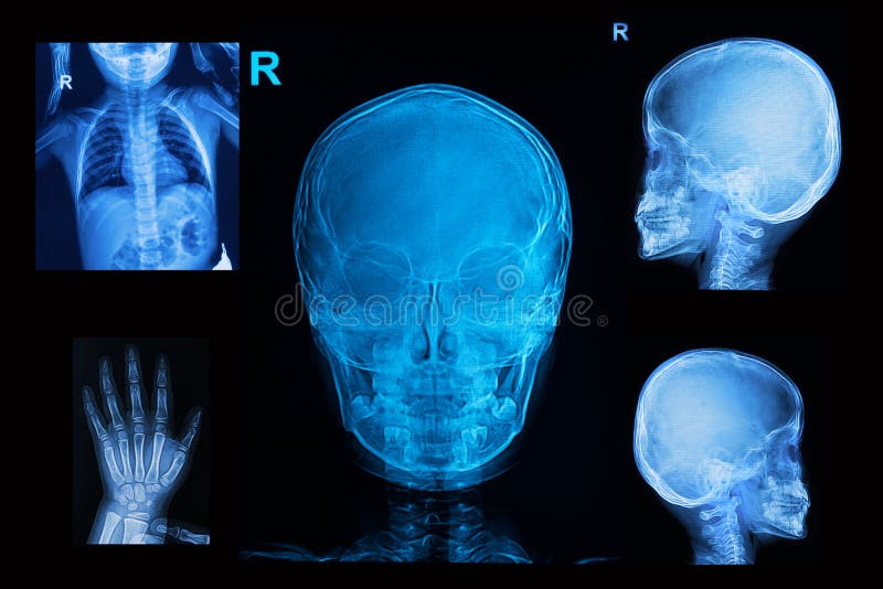 Chest x-ray of children stock photo. Image of inside - 39255654