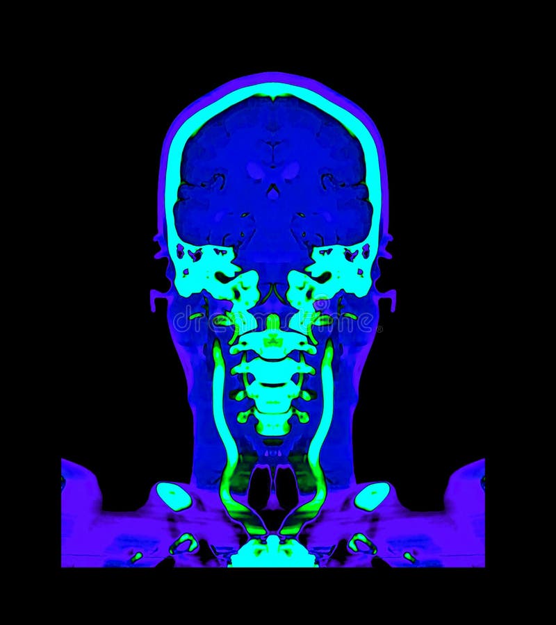 Collection of CTA Brain or CT Angiography of the Brain Comparison Mip ...