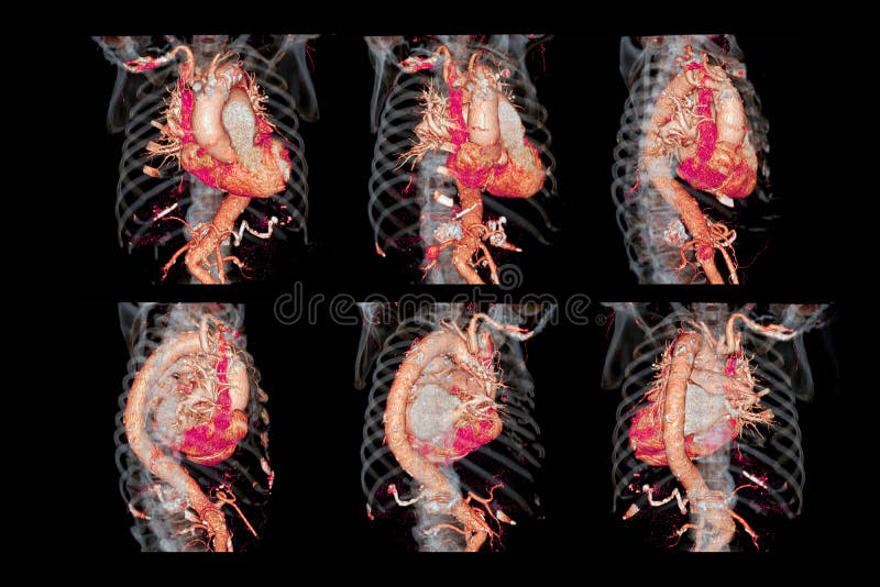 Collection of CTA Thoracic Aorta 3D Rendering Image. Stock Illustration ...