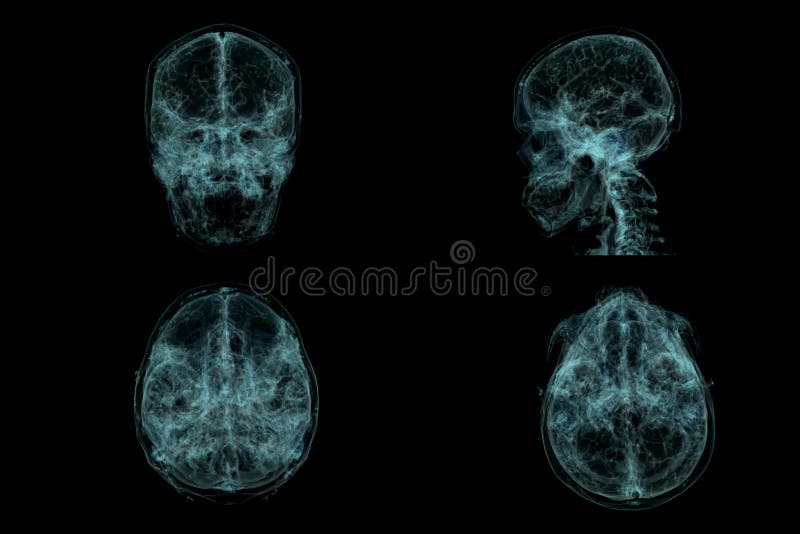 Human Skull, Brain by CT Scan. X-ray Visualization Inside of Skull ...