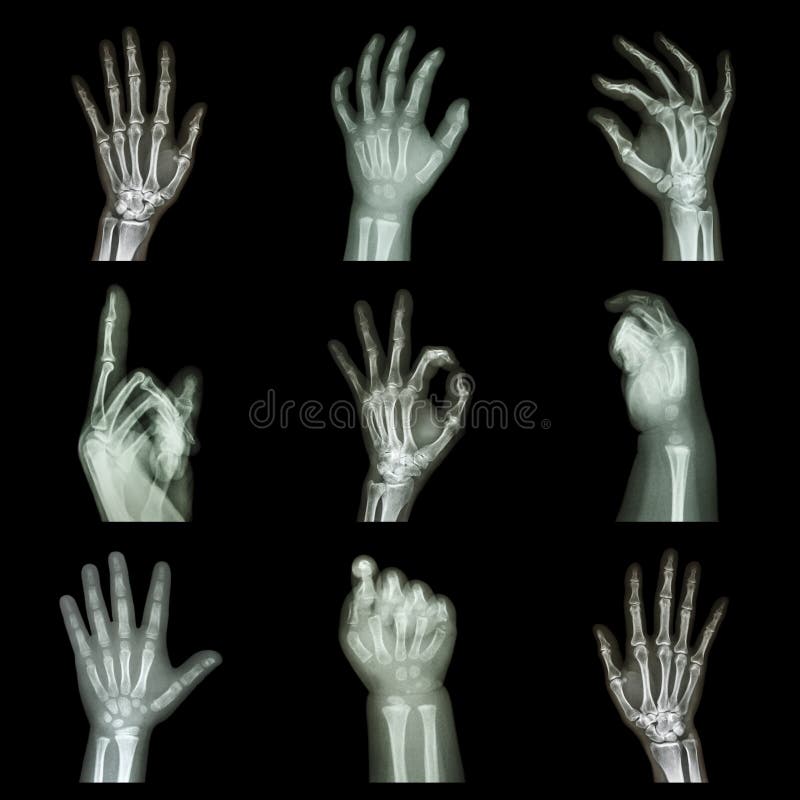 X Ray Hand Signal Stock Photos - Free & Royalty-Free Stock Photos from ...