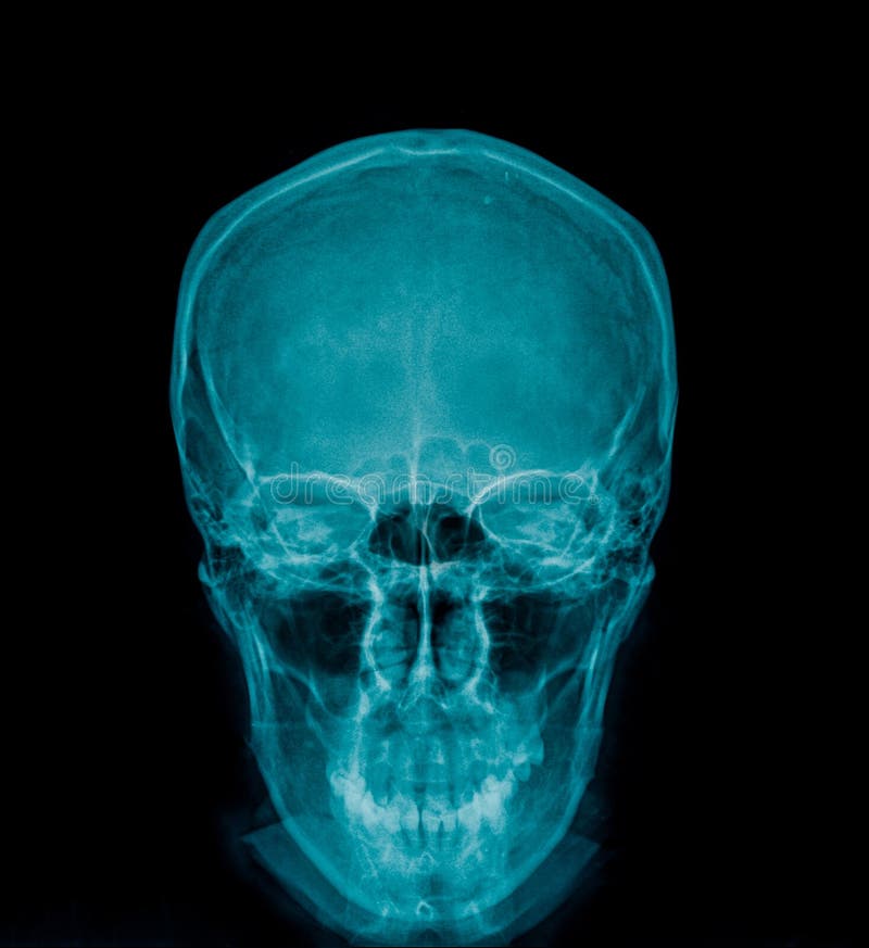 Collection Skull X-ray AP and Lateral View Stock Image - Image of ...