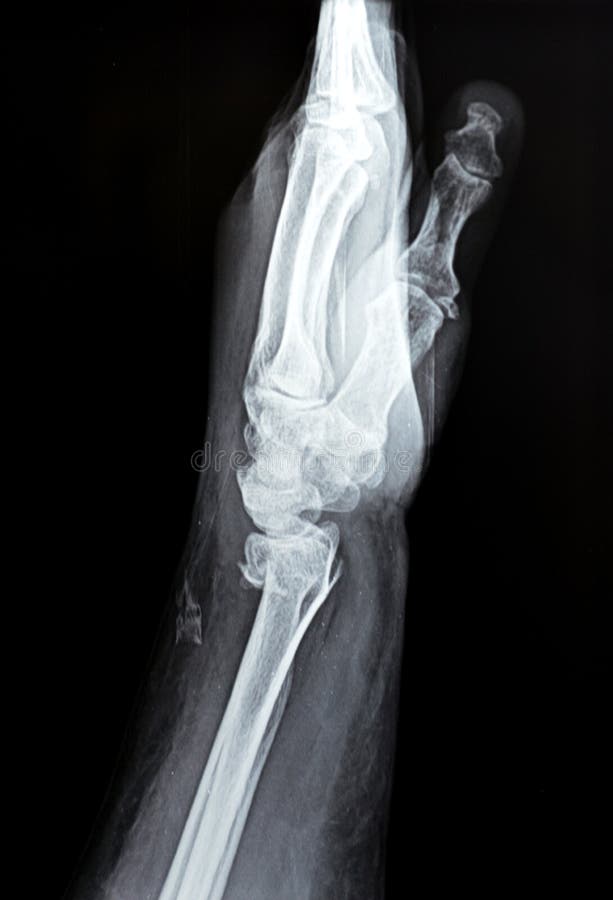 Colles Fracture of an Old Female, a Type of Fracture of the Distal ...