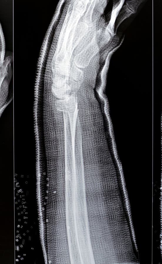 Colles Fracture Reduction of an Old Female, a Type of Fracture of the ...