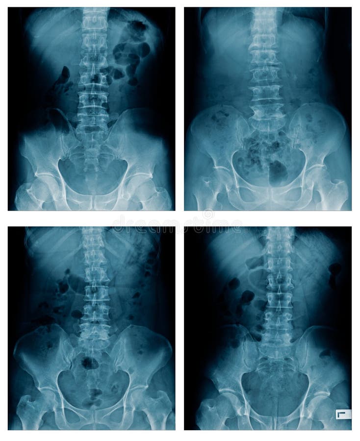 Colletion spine stock image. Image of medicine, collection - 111400547