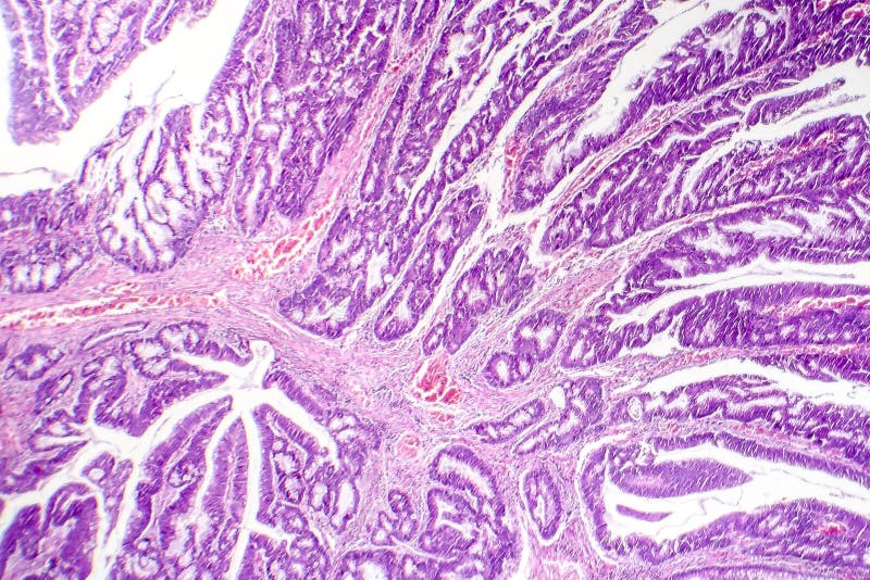 Colon Adenocarcinoma, Cancer of Colon Stock Image - Image of neoplasm ...