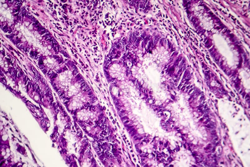 Colon Adenocarcinoma, Cancer of Colon Stock Image - Image of oncology ...