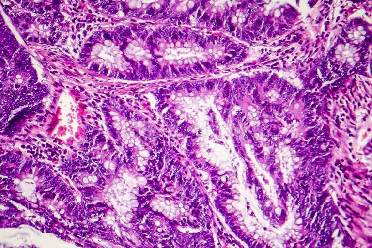 Colon Adenocarcinoma, Cancer of Colon Stock Photo - Image of colon ...