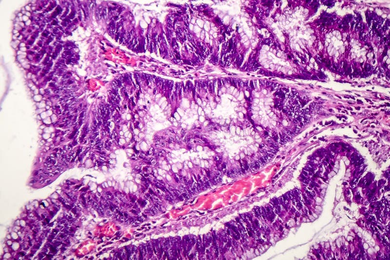 Colon Adenocarcinoma, Cancer of Colon Stock Photo - Image of ...