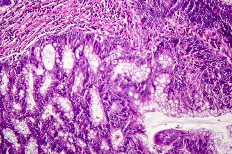 Colon Adenocarcinoma, Cancer of Colon Stock Image - Image of ...