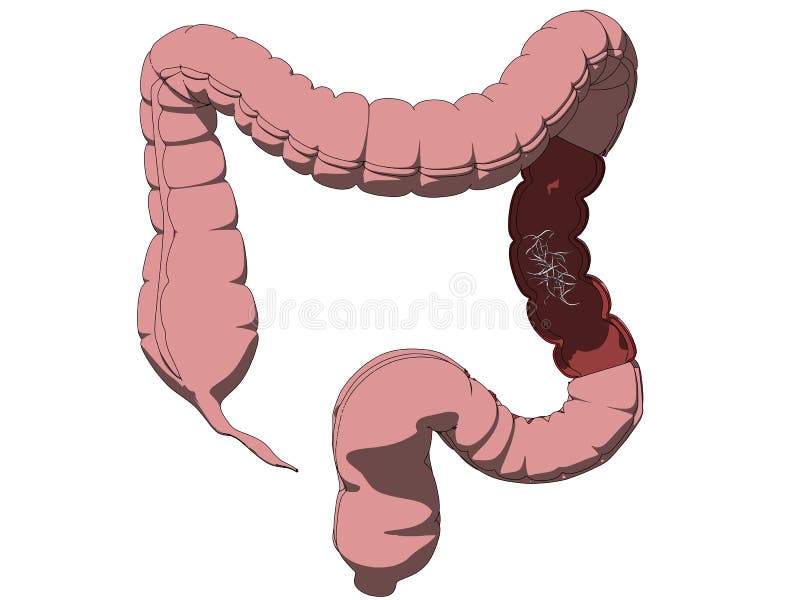 Colon with adult pinworms stock vector. Illustration of disease - 9679401