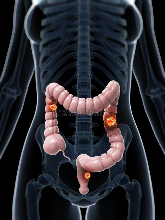Colon Cancer Stock Illustration Illustration Of Colon 11733971