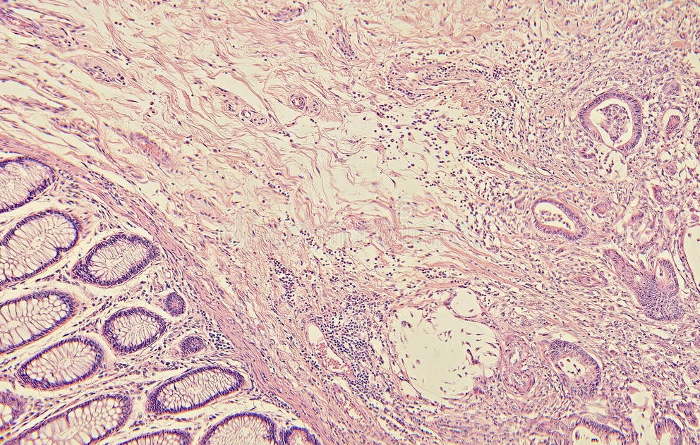 Colon Cancer Histology stock image. Image of microscope - 4972793