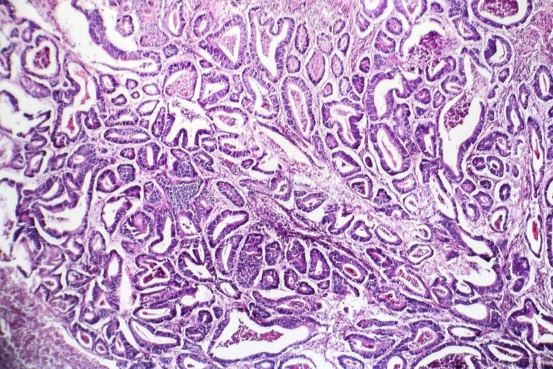 Colon Cancer, Illustration and Photo Under Microscope Stock ...