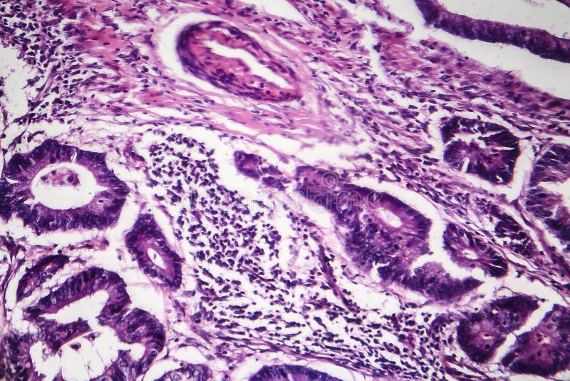 Colon Cancer, Light Micrograph Stock Illustration - Illustration of ...