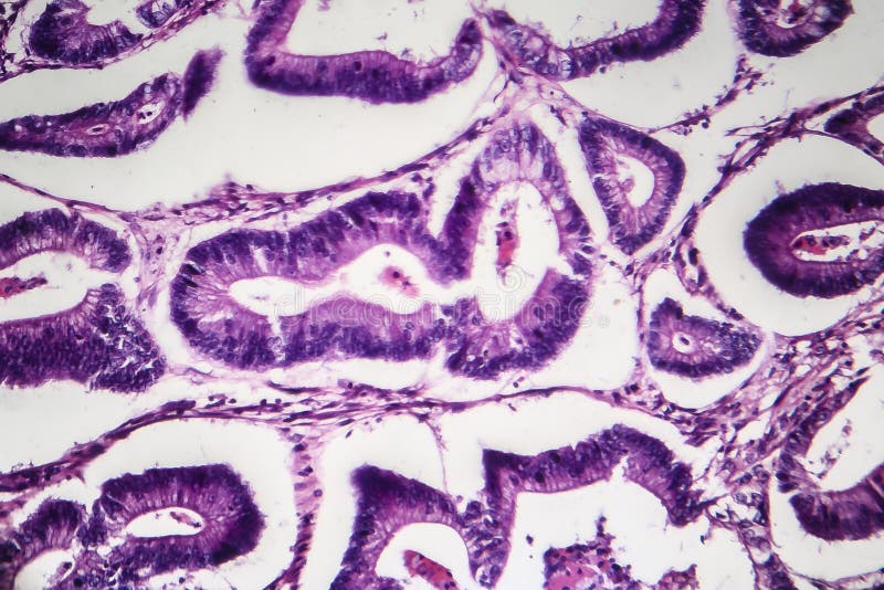 Colon Cancer, Light Micrograph Stock Illustration - Illustration of ...