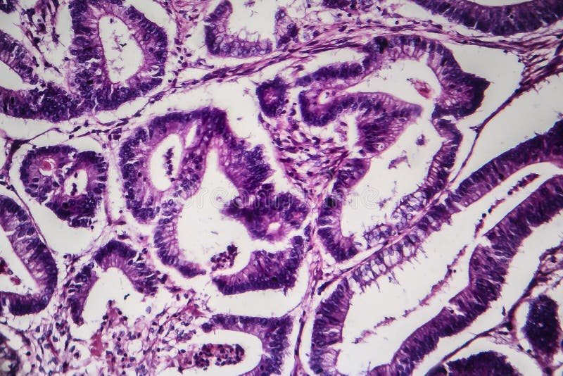 Colon Cancer, Illustration and Photo Under Microscope Stock ...