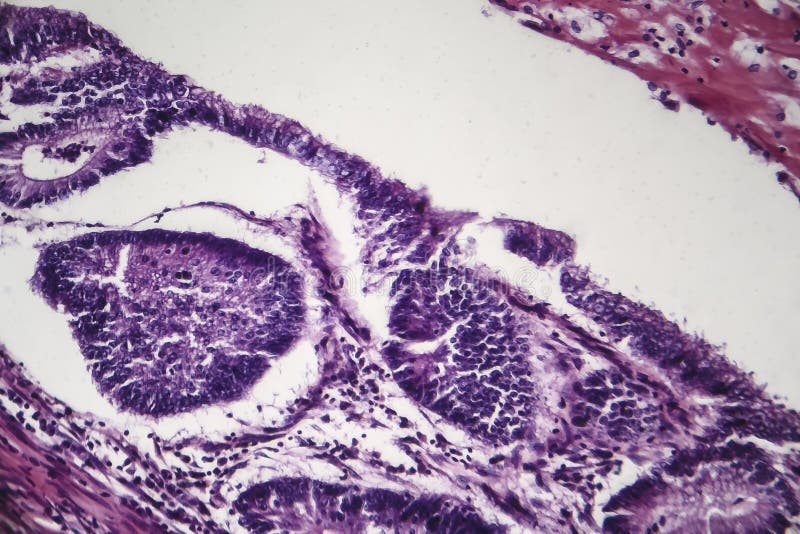 Colon Cancer Cells Under Microscope