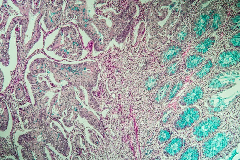 Colon Cancer Tissue Under the Microscope Stock Photo - Image of ...