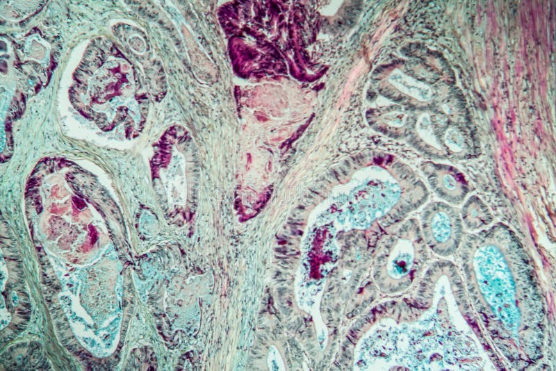 Colon Carcinoma Tissue Thin Section Stock Image - Image of ...