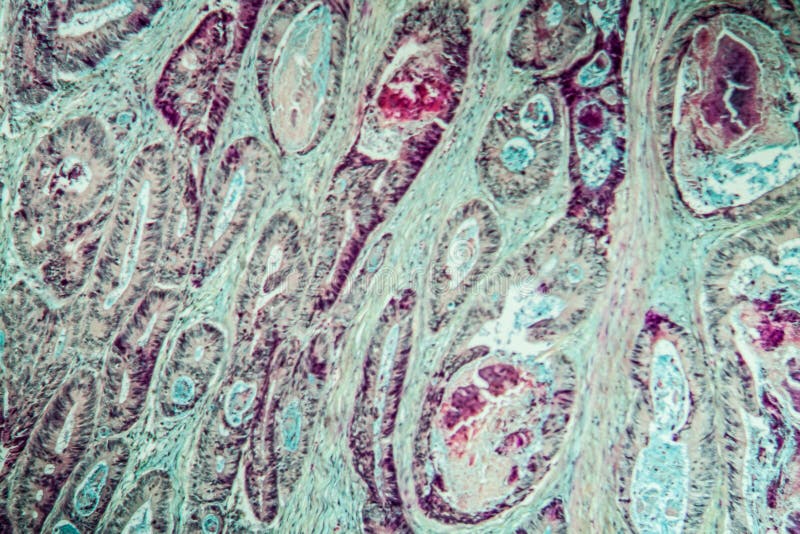 Colon Carcinoma Tissue Thin Section Stock Image - Image of science ...