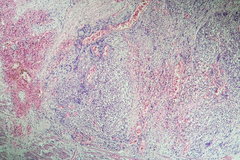 Colon Inflammation in Crohn`s Disease Stock Image - Image of cells ...