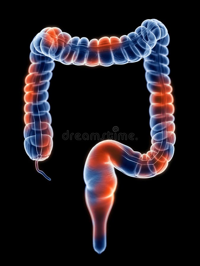 Colon inflammation stock illustration. Illustration of medicine - 73538494