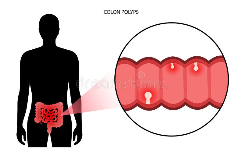 Colon polyps inflammation stock vector. Illustration of body - 225690420