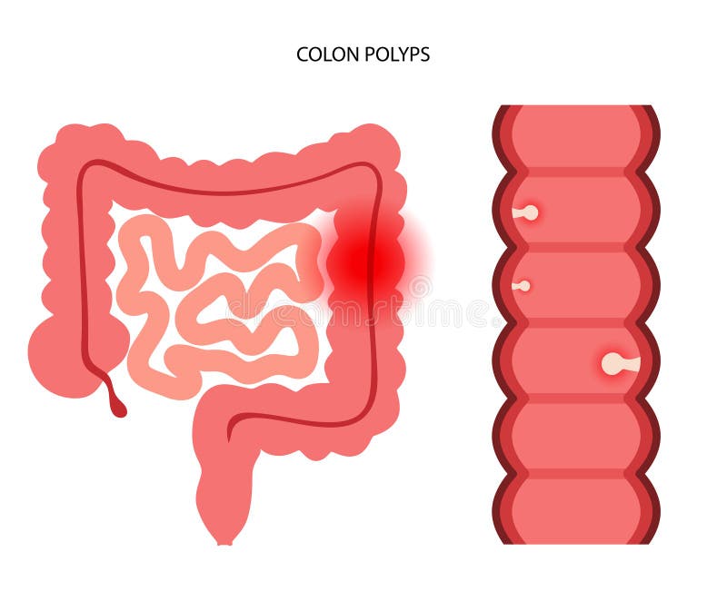 Colon polyps inflammation stock vector. Illustration of esophagus ...