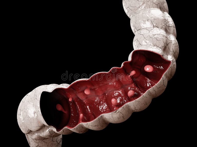 Colon Polyps. 3d Illustration, Polyp in the Intestine. Stock ...