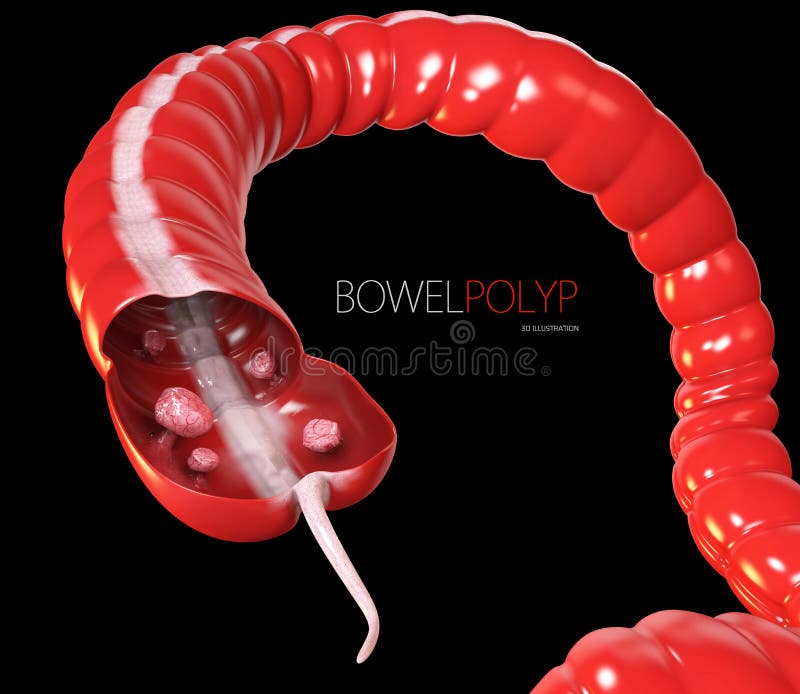 3d Illustration Of Colon Polyps Polyp In The Intestine Isolated Black